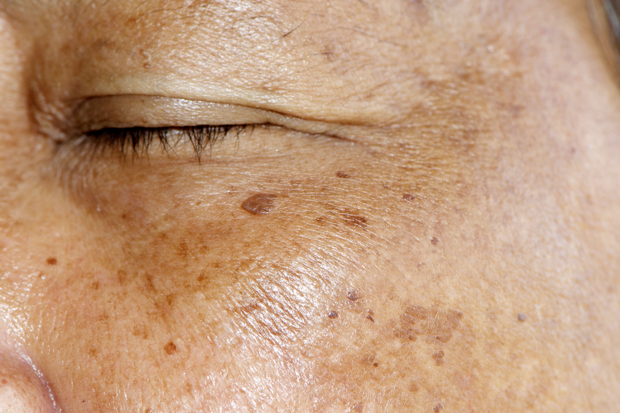 Brown Spots on Skin: How to Identify Freckles, Age Spots, and Signs of ...